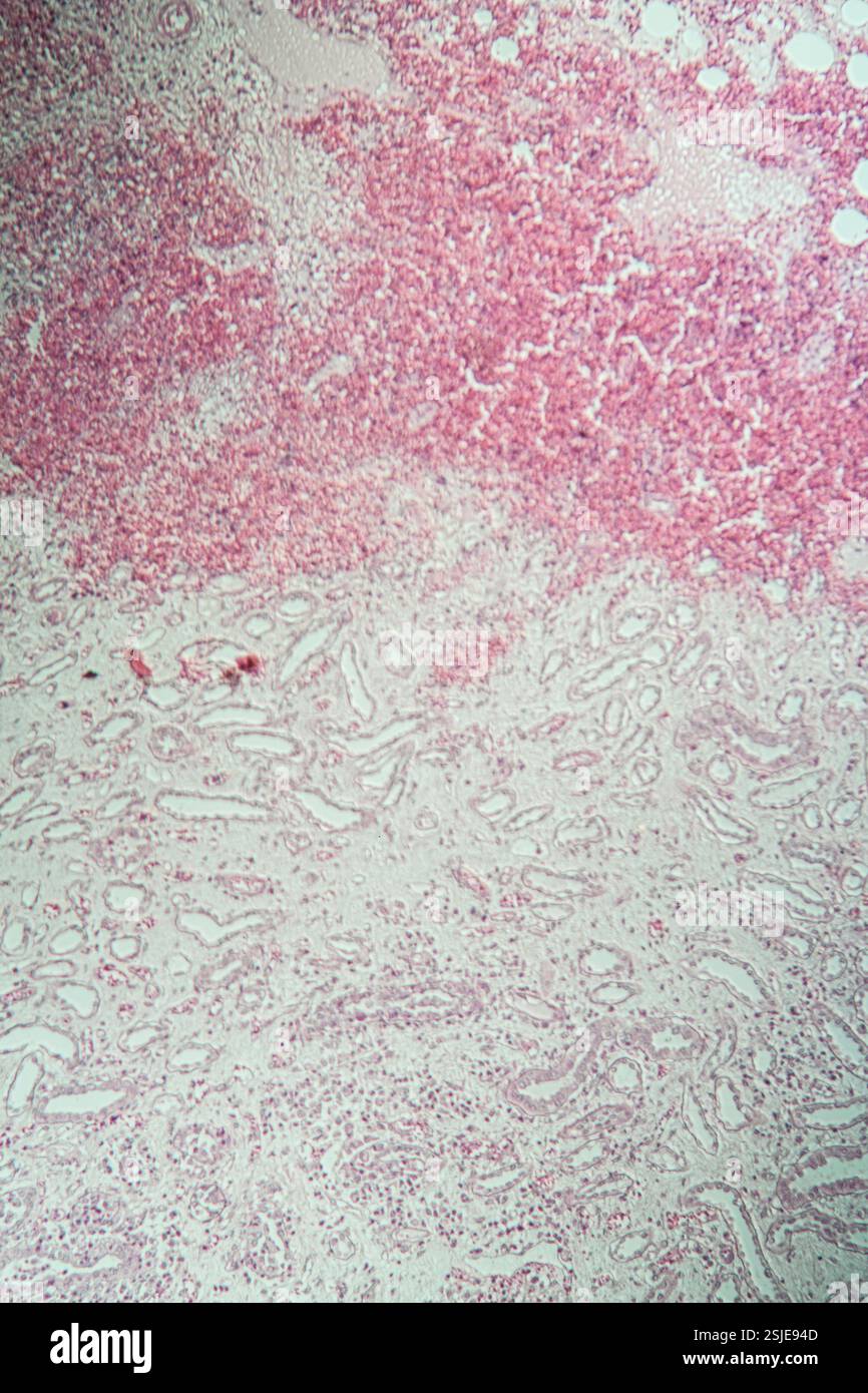 Poly nephritis, tissue under the microscope 100x Stock Photo - Alamy