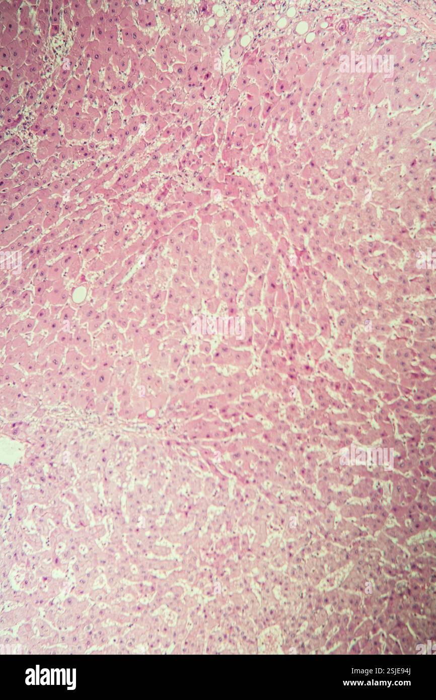 Liver diseased tissue under the microscope 100x Stock Photo - Alamy