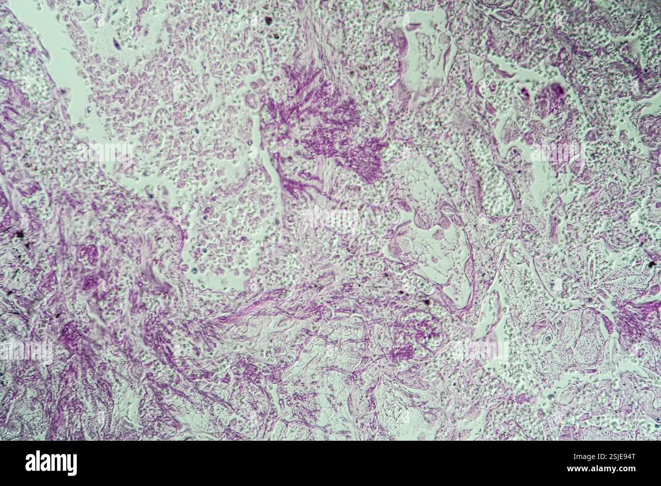 Infection with Candida and Aspergillus 200x Stock Photo - Alamy