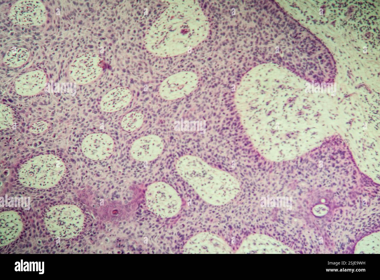 Diseased tissue under the microscope 100x Stock Photo - Alamy