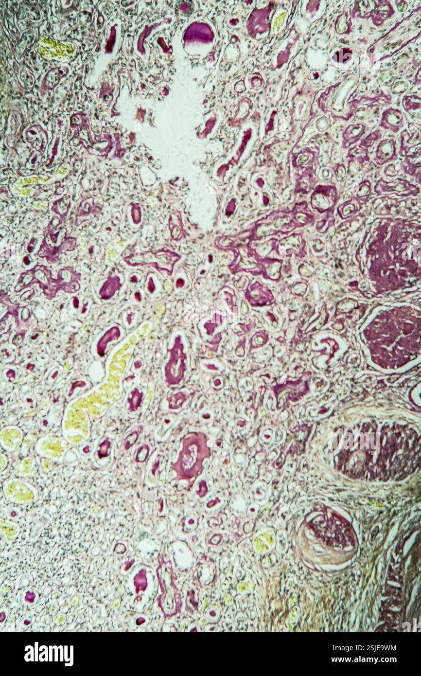 Diseased tissue under the microscope 100x Stock Photo - Alamy