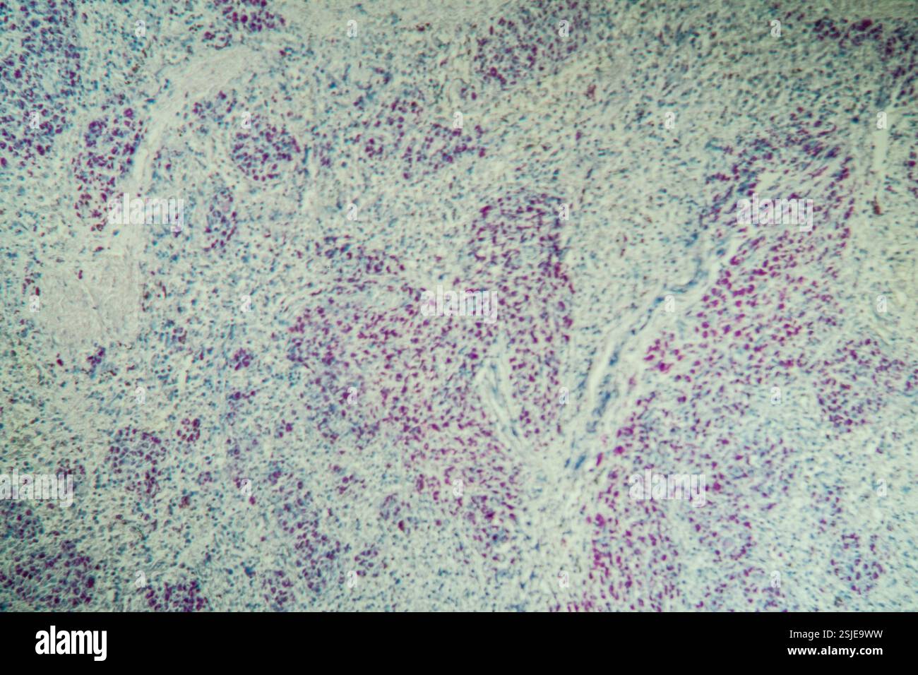 Tissue infected by bacteria under the microscope 100x Stock Photo - Alamy