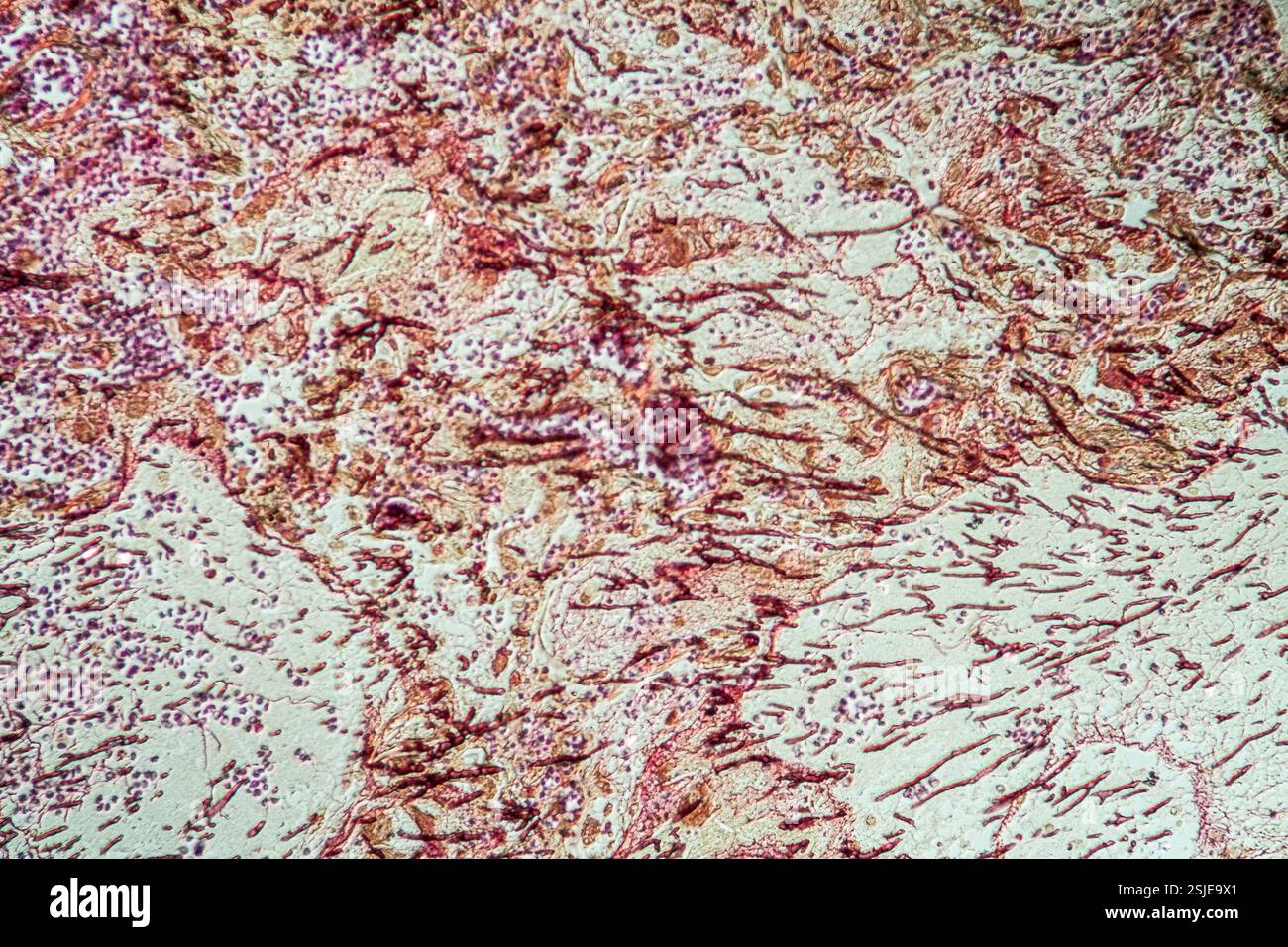 Lung tissue infected with fungus under the microscope 200x Stock Photo ...