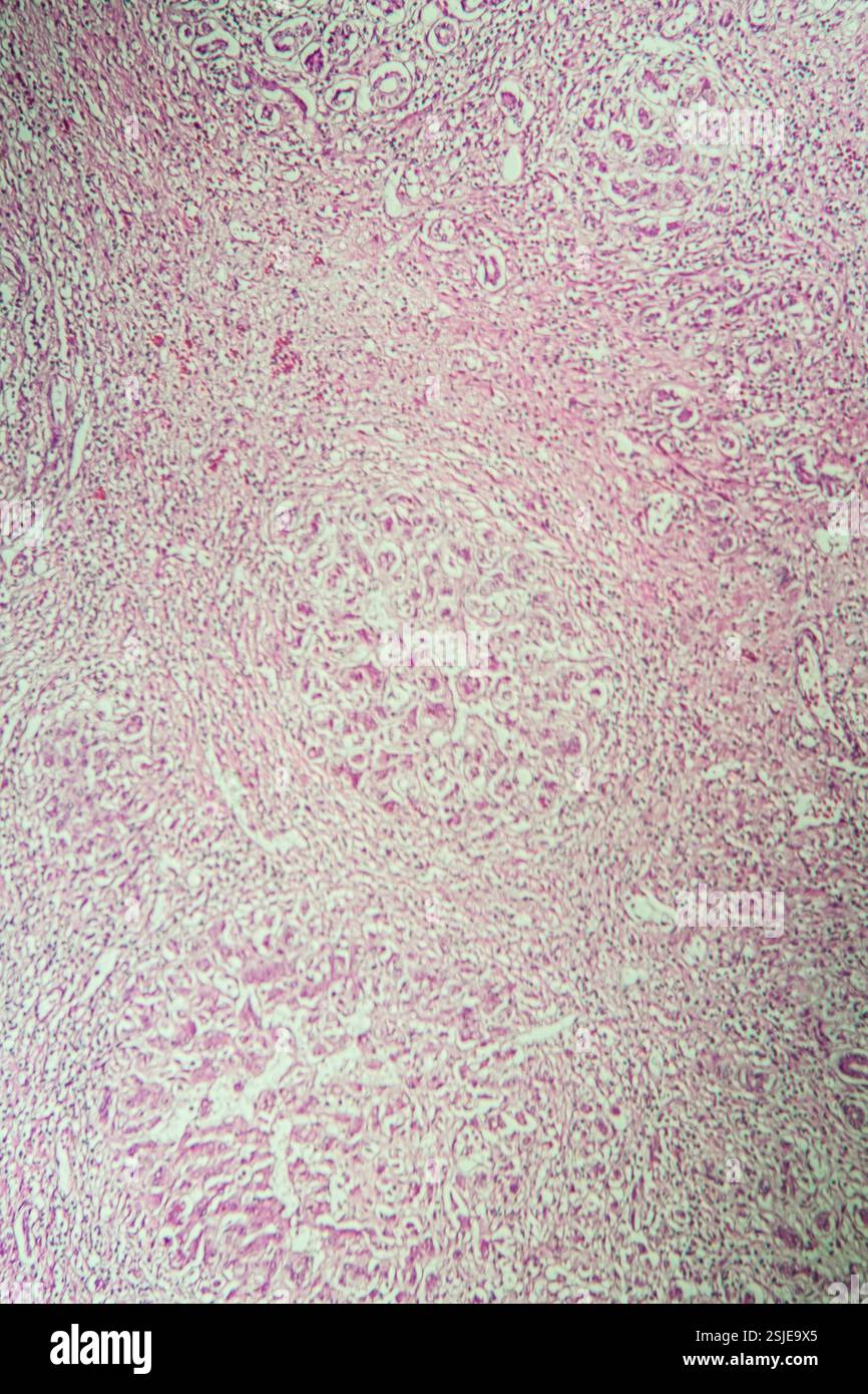 Liver diseased tissue under the microscope 100x Stock Photo - Alamy