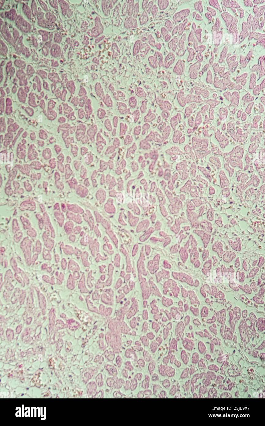 Heart muscle diseased tissue under the microscope 200x hi-res stock ...