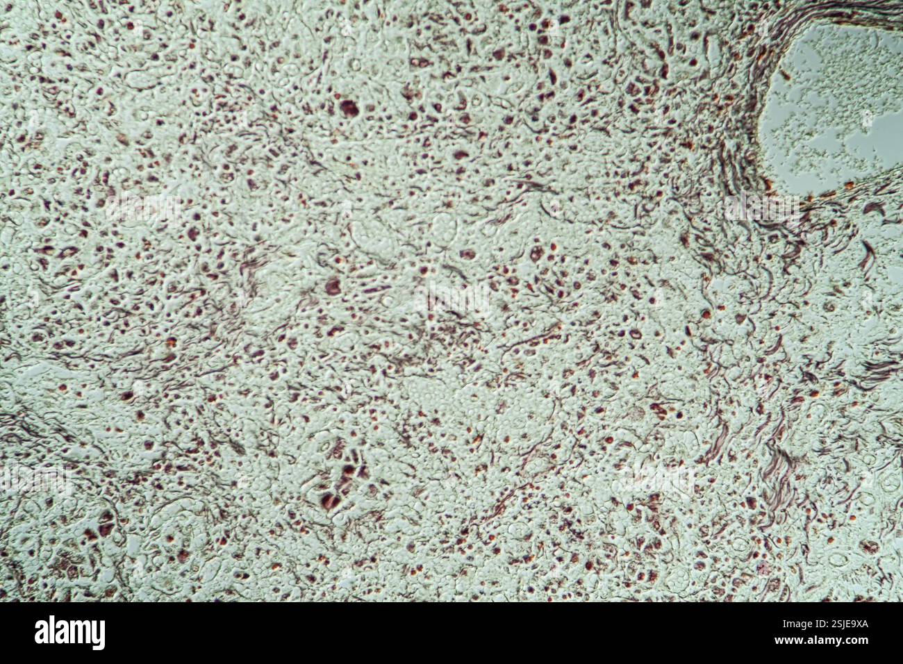 Pneumocyctis tissue under the microscope 100x hi-res stock photography ...