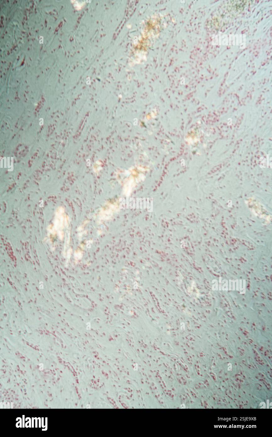 Kidney Gout Tissue under the microscope 100x Stock Photo - Alamy