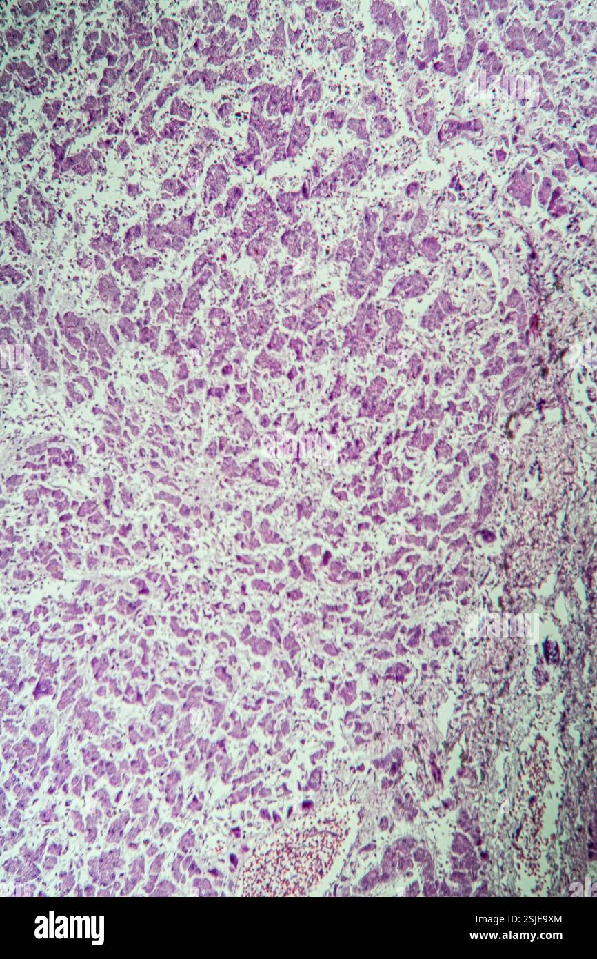 Diseased tissue under the microscope 100x Stock Photo - Alamy