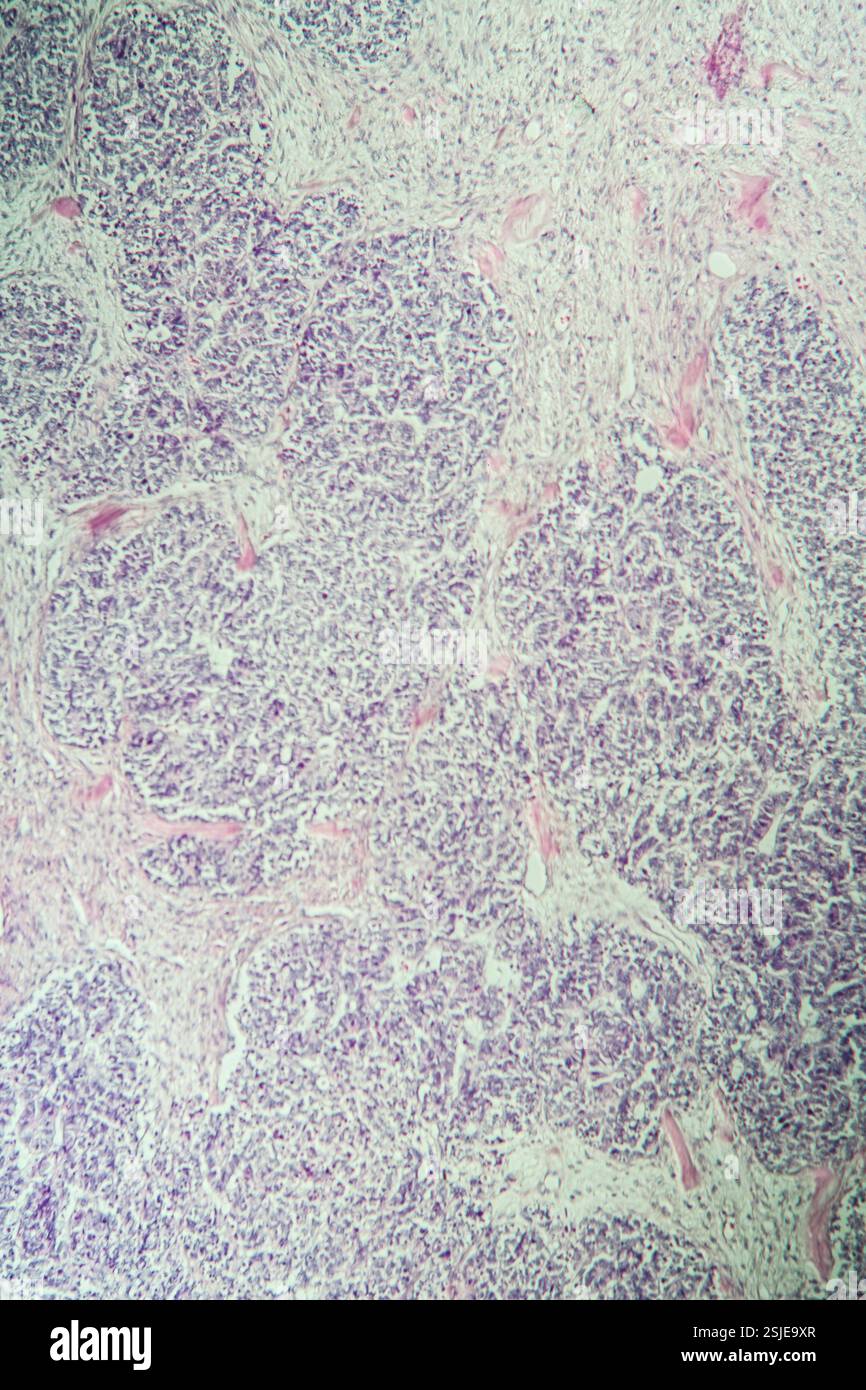 Diseased tissue under the microscope 100x Stock Photo - Alamy