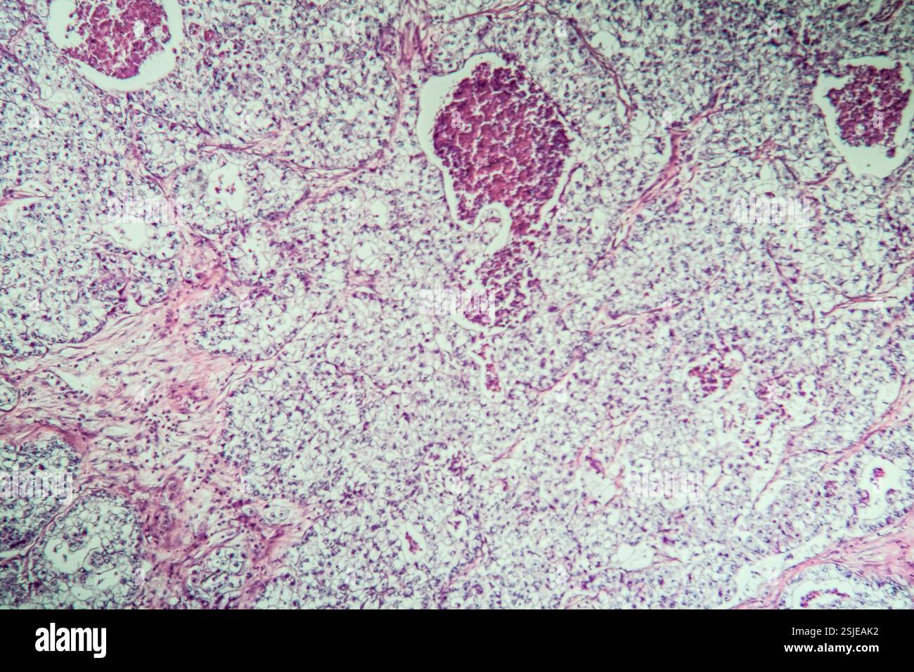 Ovarian diseased tissue under the microscope 100x Stock Photo - Alamy