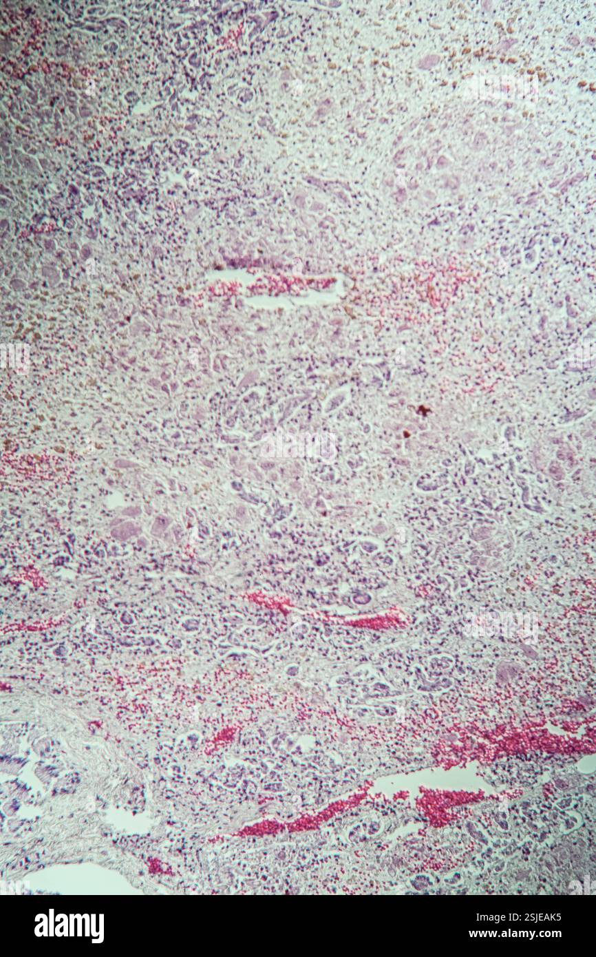 Diseased liver tissue under the microscope 100x Stock Photo - Alamy