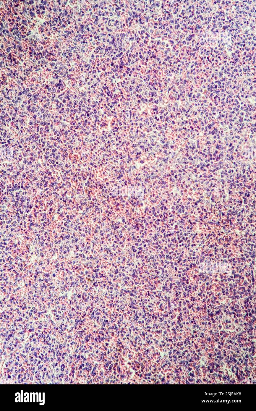 Liver diseased tissue under the microscope 100x Stock Photo - Alamy