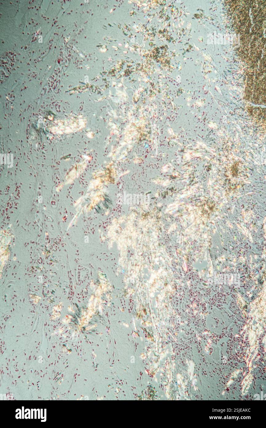 Diseased tissue under the microscope 100x Stock Photo - Alamy