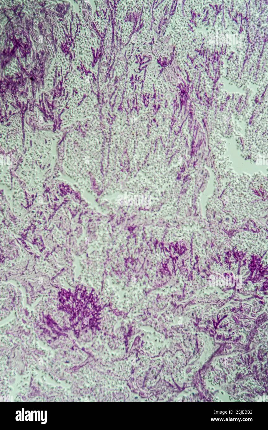 Infection with Candida and Aspergillus 200x Stock Photo - Alamy