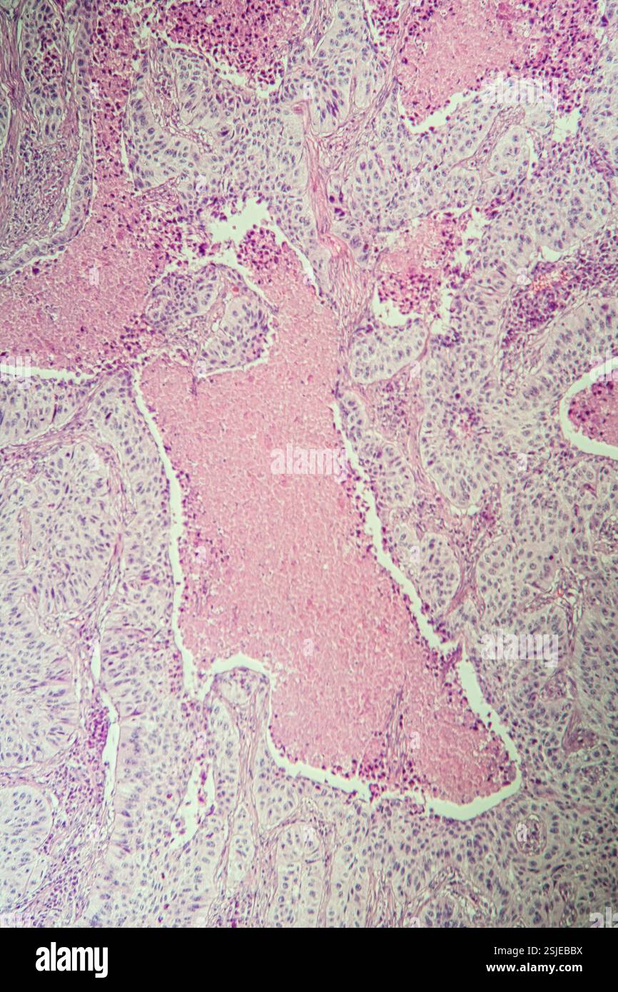 Diseased tissue under the microscope 100x Stock Photo - Alamy