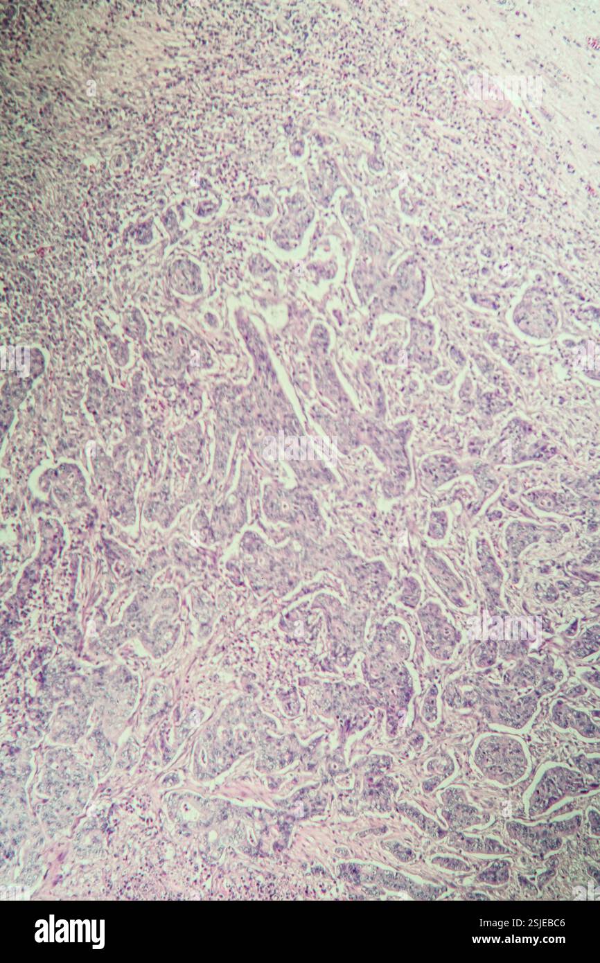 Cancer tissue under the microscope 100x Stock Photo - Alamy
