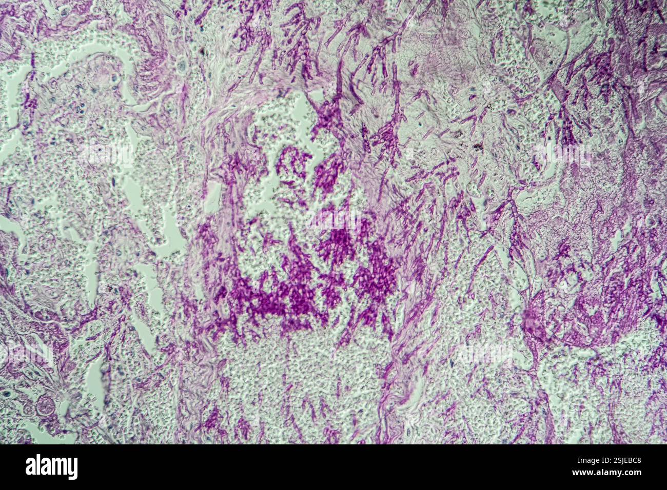 Infection with candida and aspergillus 200x hi-res stock photography ...