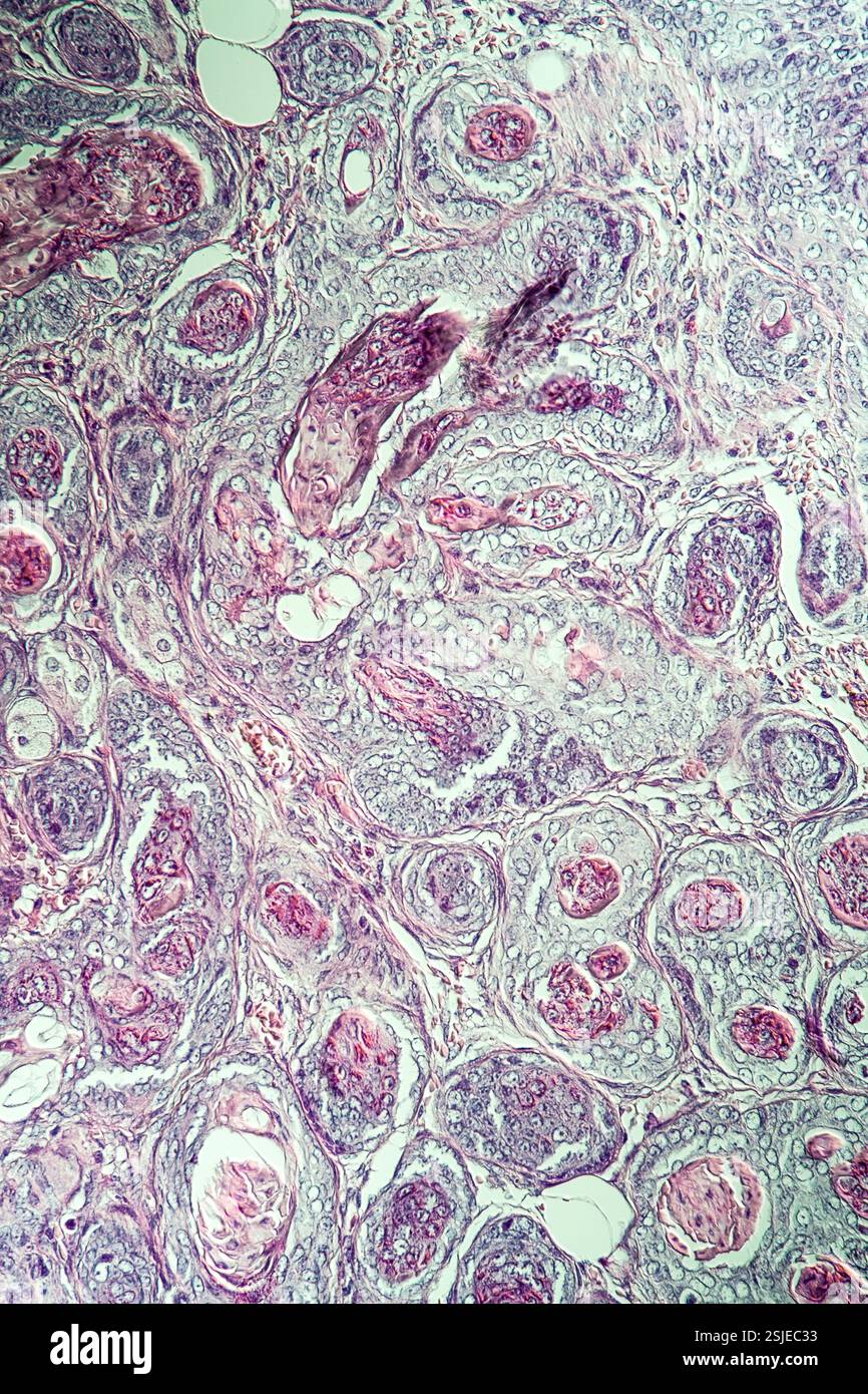 Carcinoma in guinea pigs, tissue under the microscope 200x Stock Photo ...