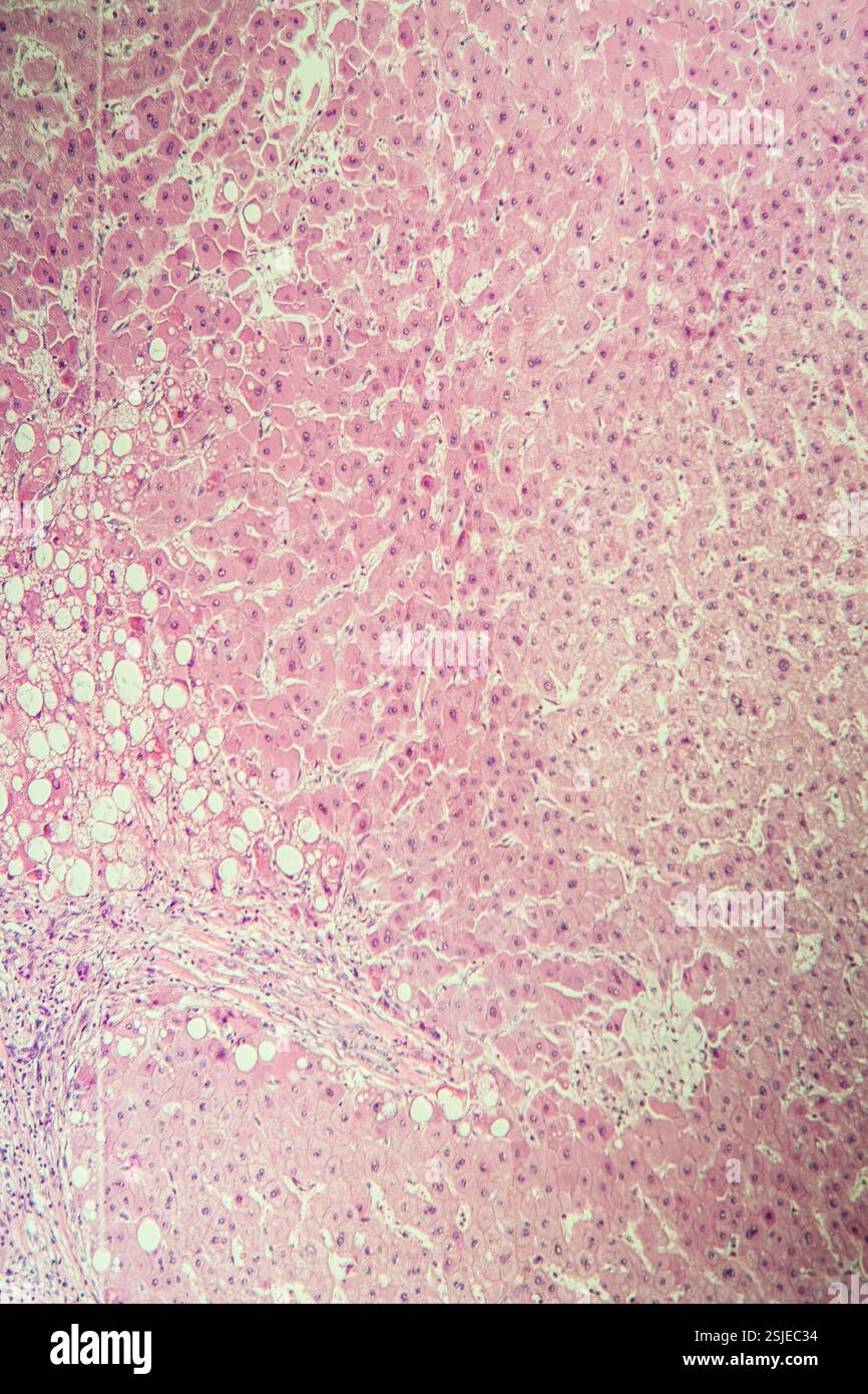 Diseased tissue under the microscope 100x Stock Photo - Alamy