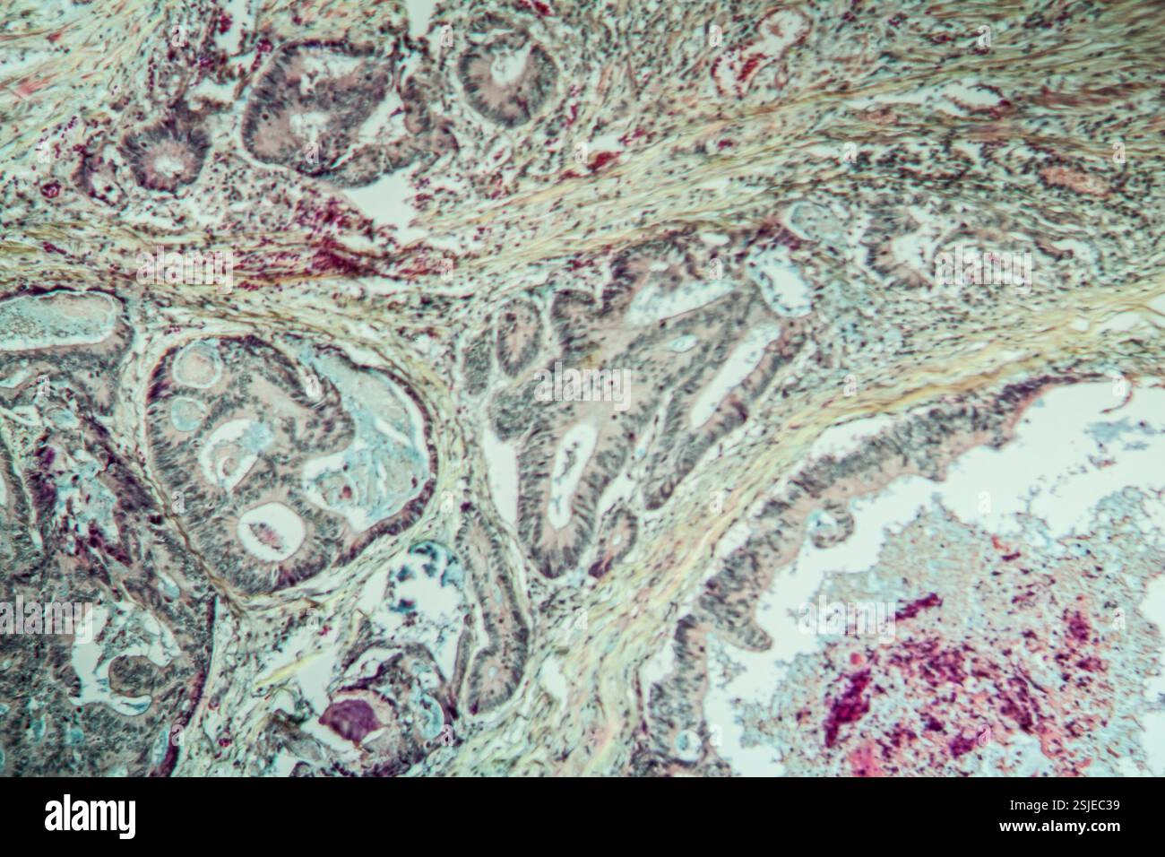 Colon cancer tissue under the microscope 100x Stock Photo - Alamy