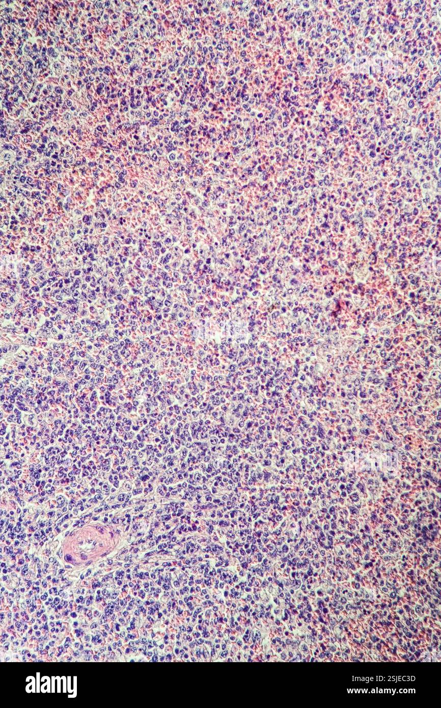 Diseased liver tissue under the microscope 100x Stock Photo - Alamy