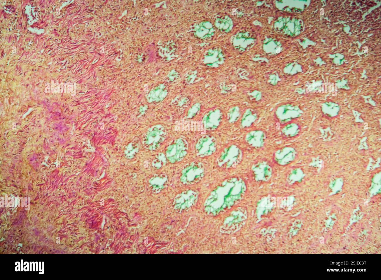 Diverticula in colon tissue under the microscope 100x Stock Photo - Alamy