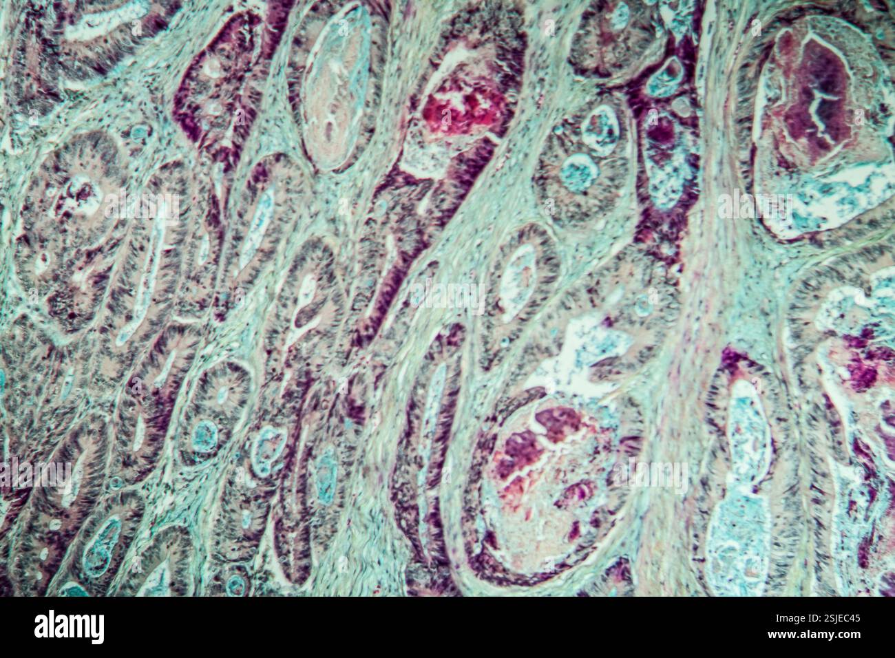 Colon carcinoma Tissue under the microscope 100x Stock Photo - Alamy