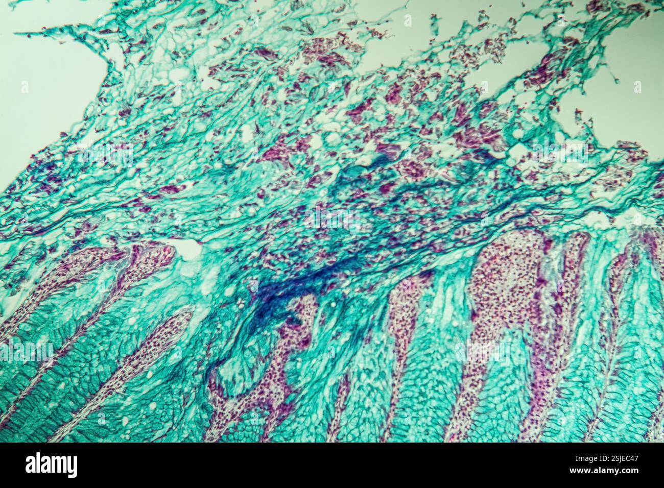 Colon cancer tissue under the microscope 100x Stock Photo - Alamy