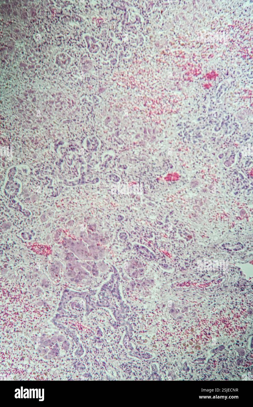 Diseased liver tissue under the microscope 100x Stock Photo - Alamy