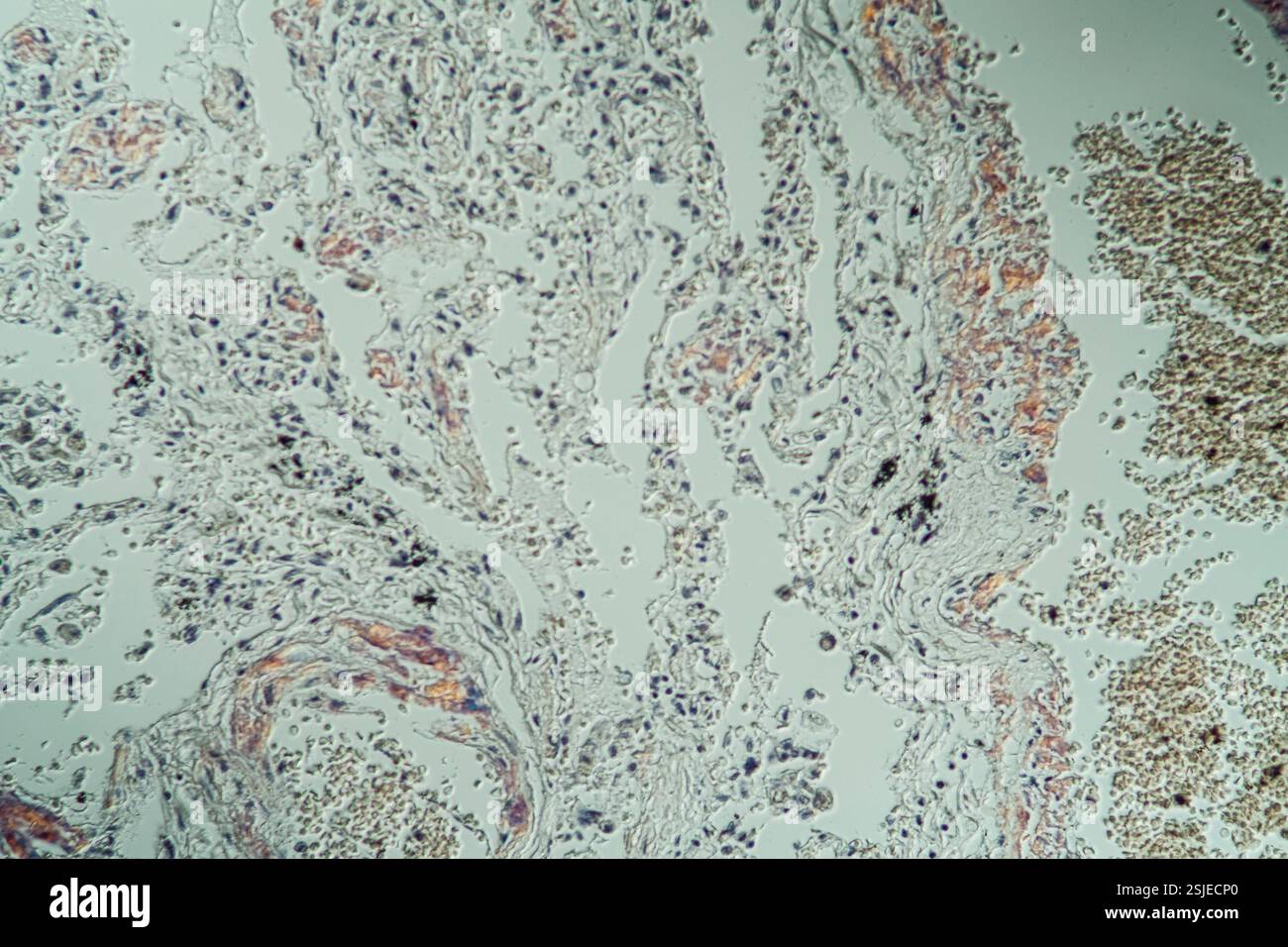 Diseased tissue under the microscope 200x hi-res stock photography and ...