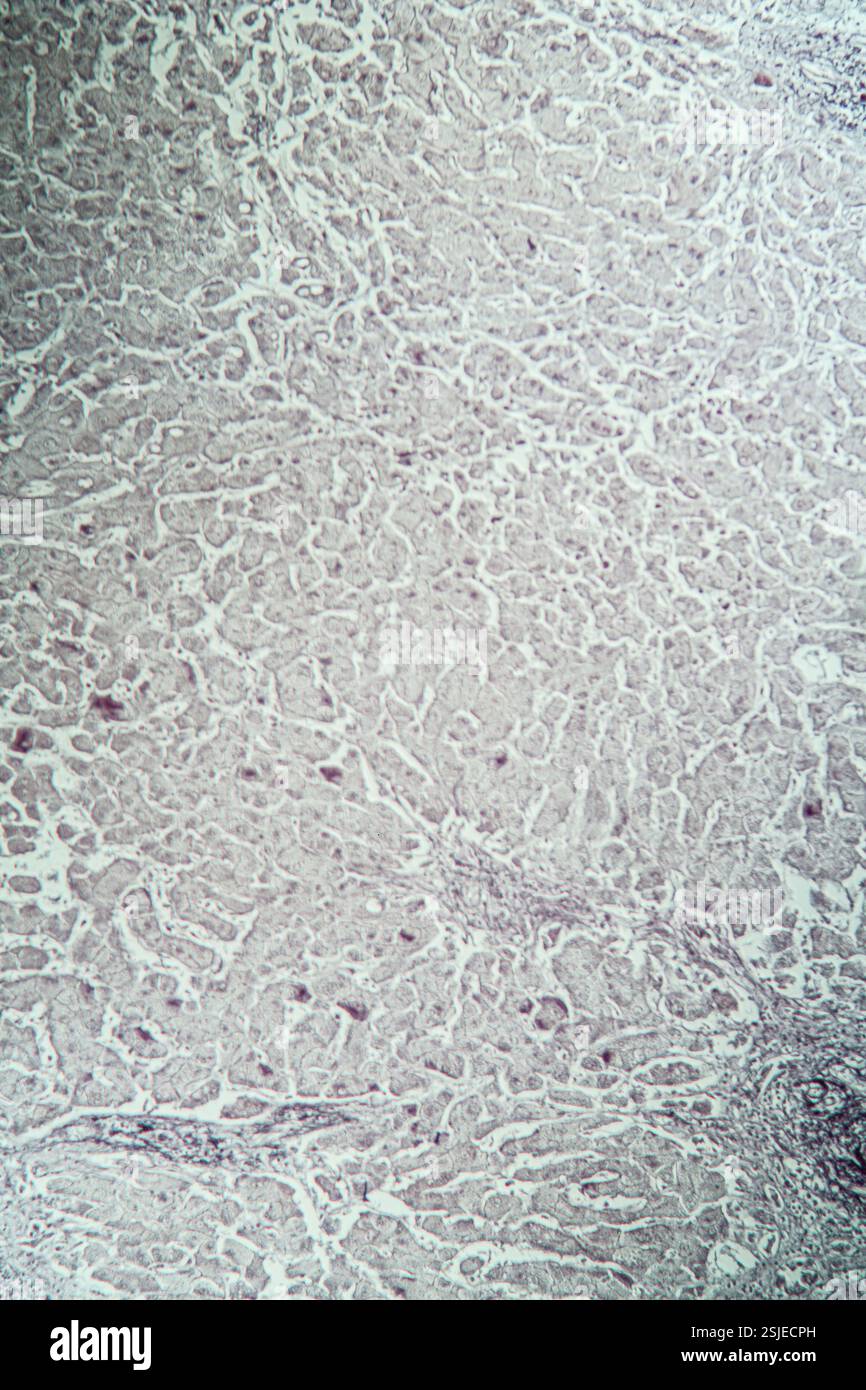 Liver diseased tissue under the microscope 100x Stock Photo - Alamy