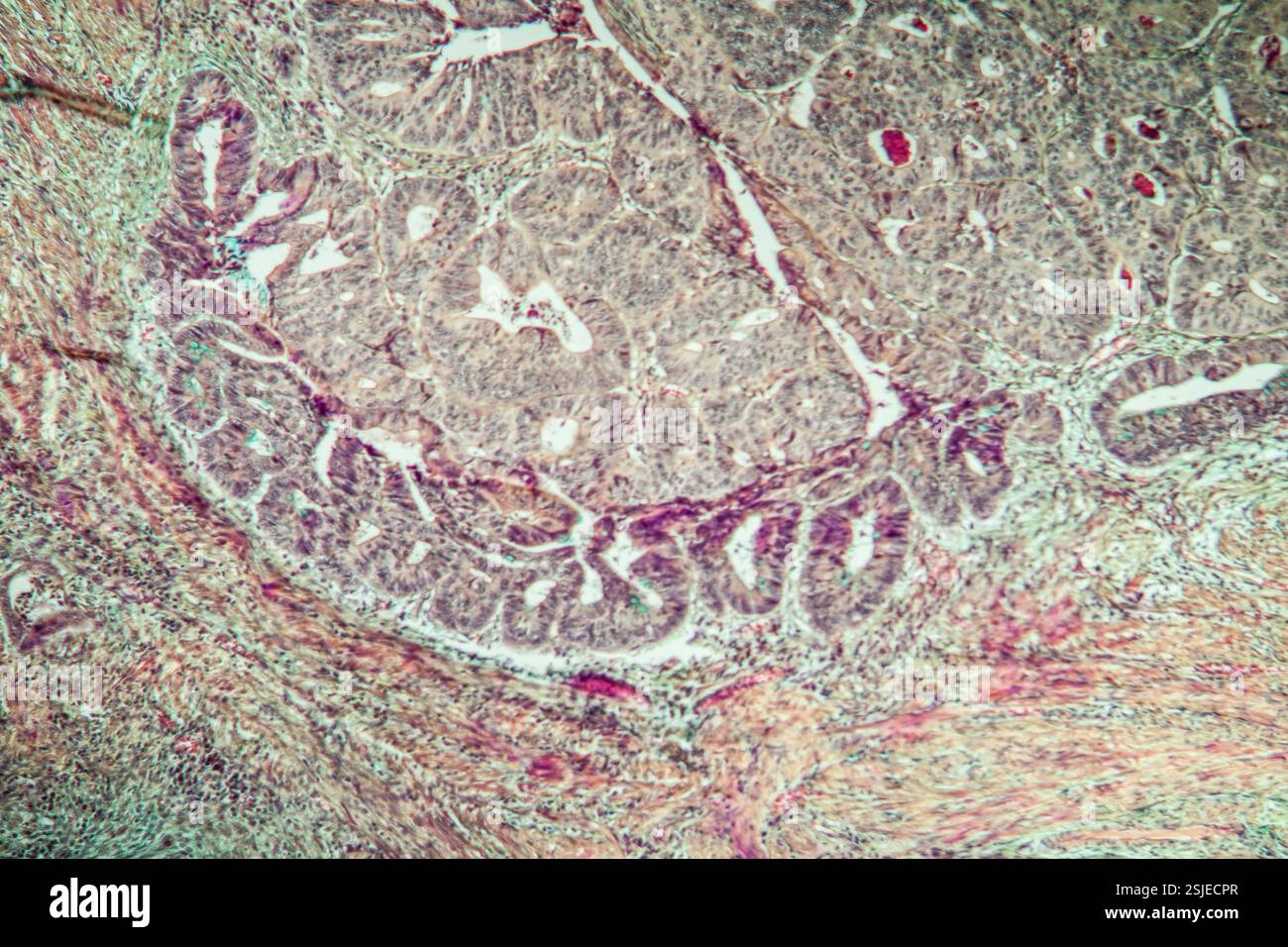 Colon cancer tissue under the microscope 100x Stock Photo - Alamy