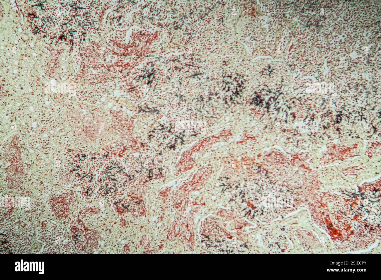 Lung tissue with fungal infestation under the microscope 100x Stock ...