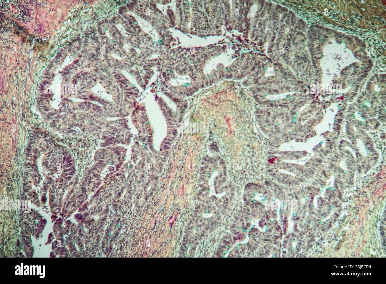 Colon cancer tissue under the microscope 100x Stock Photo - Alamy