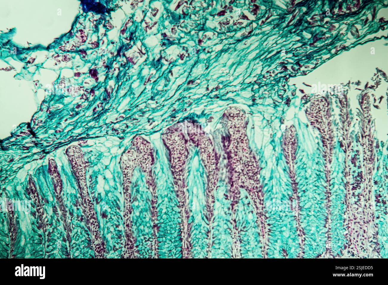 Colon cancer tissue under the microscope 100x Stock Photo - Alamy