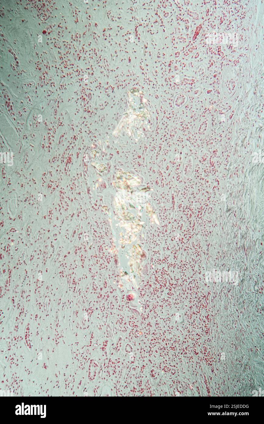 Gout tissue under the microscope 100x Stock Photo - Alamy