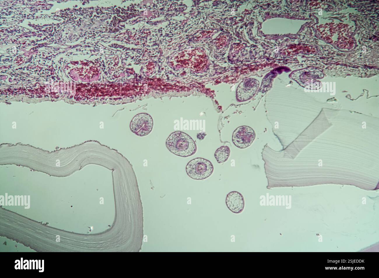 Carcinoma of the ovary tissue under the microscope hi-res stock ...