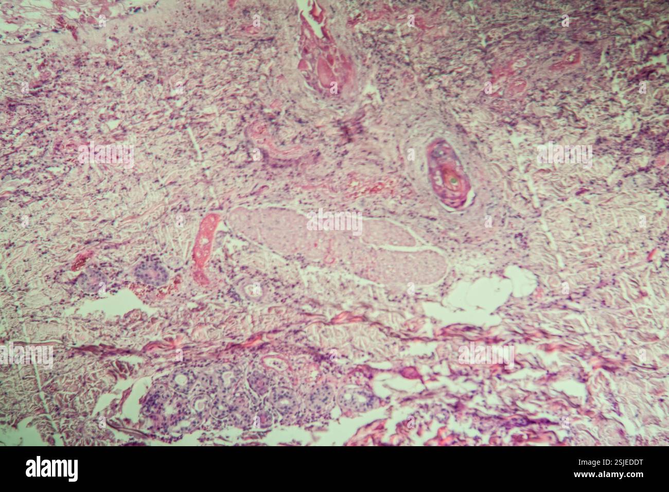 Chickenpox infected tissue under the microscope 100x Stock Photo - Alamy