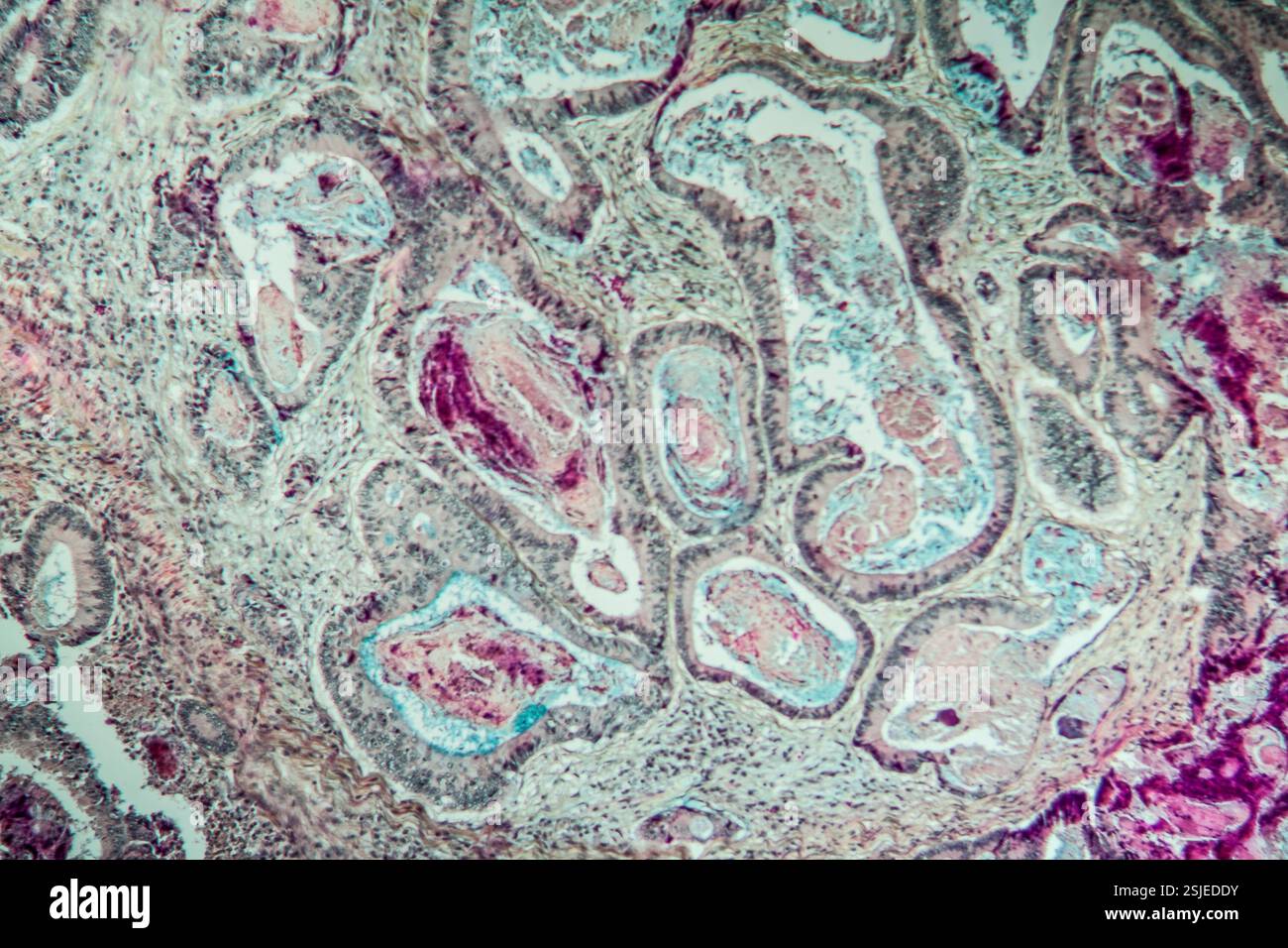 Colon carcinoma Tissue under the microscope 100x Stock Photo - Alamy