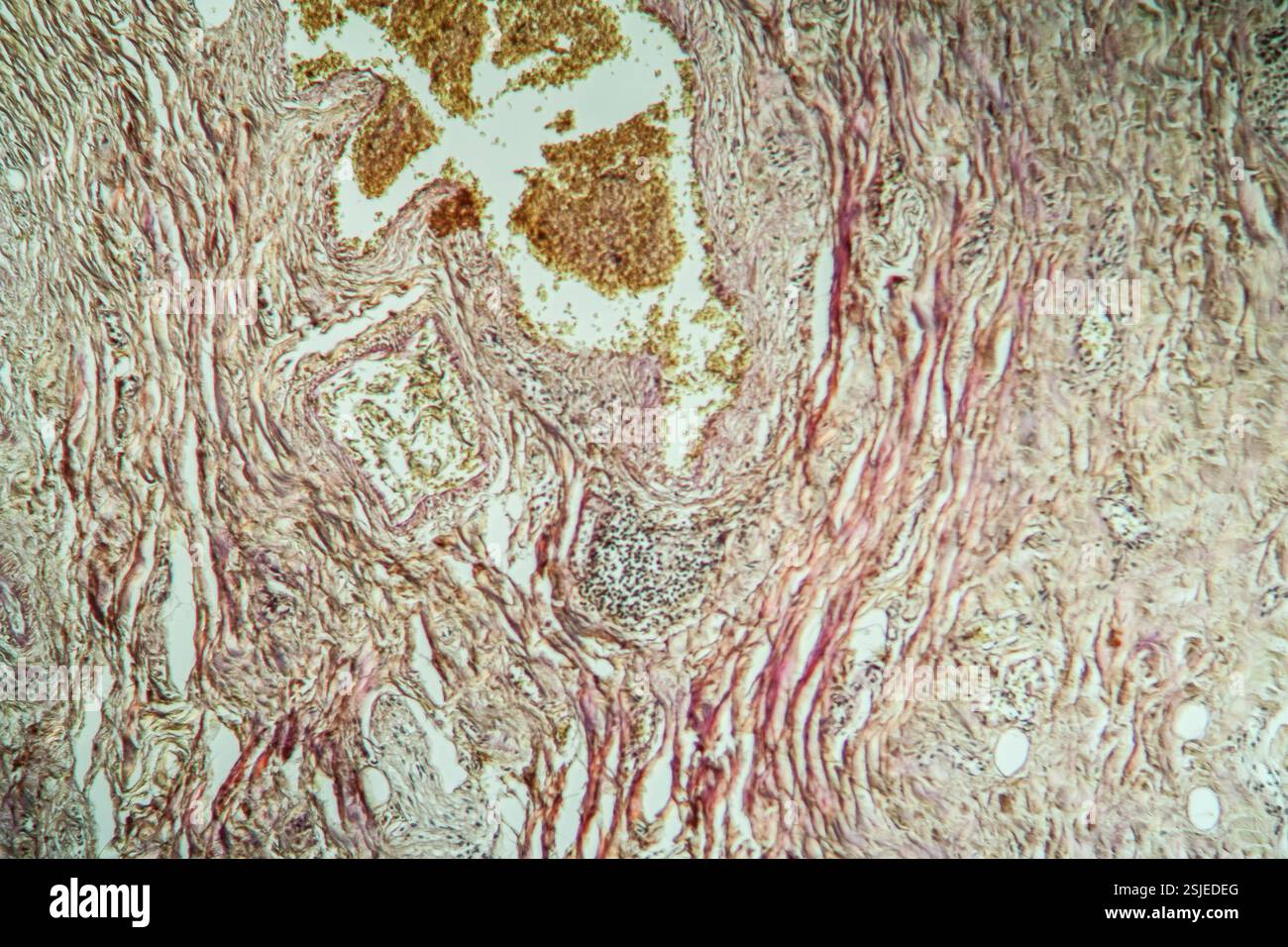 Diverticula in the colon under the microscope 100x Stock Photo - Alamy