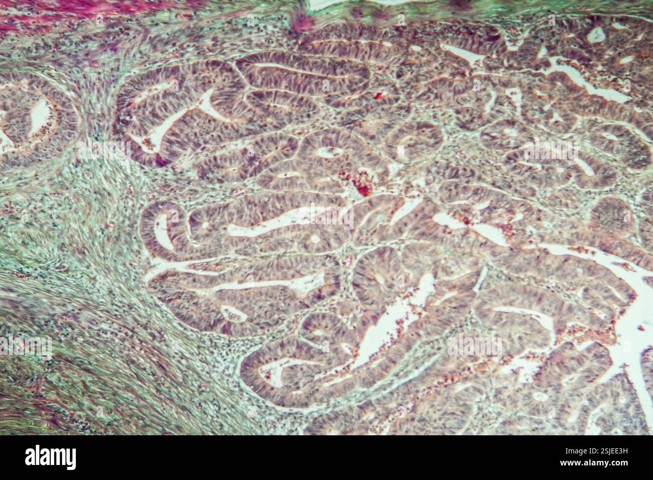 Colon carcinoma Tissue under the microscope 100x Stock Photo - Alamy