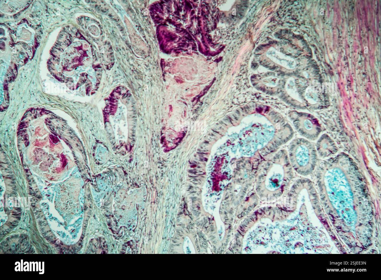 Colon cancer tissue under the microscope 100x Stock Photo - Alamy