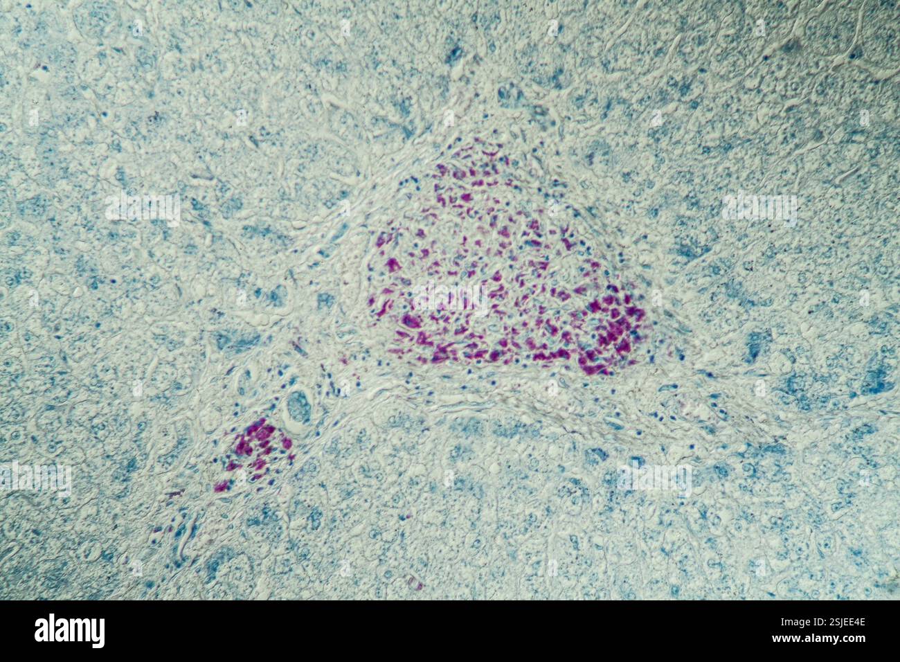 Infected tissue aids 200x hi-res stock photography and images - Alamy
