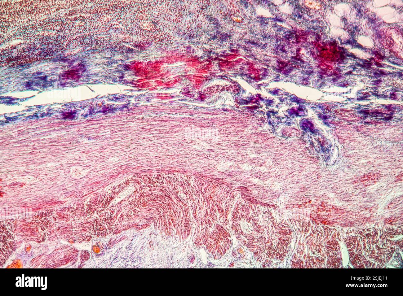 Appendix diseased tissue 100x Stock Photo - Alamy