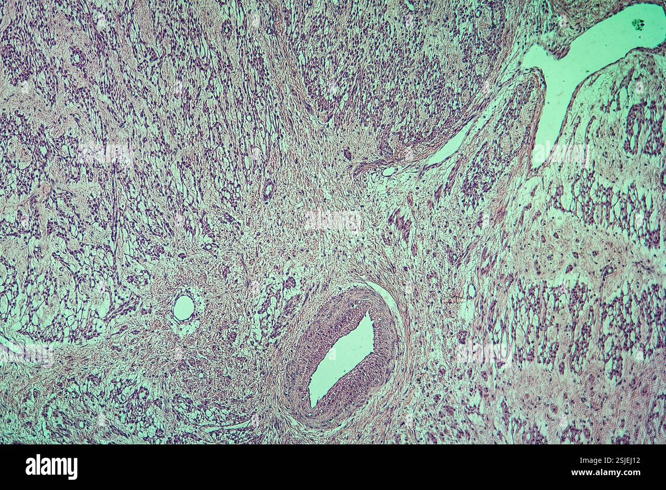 Uterus diseased tissue 100x Stock Photo - Alamy