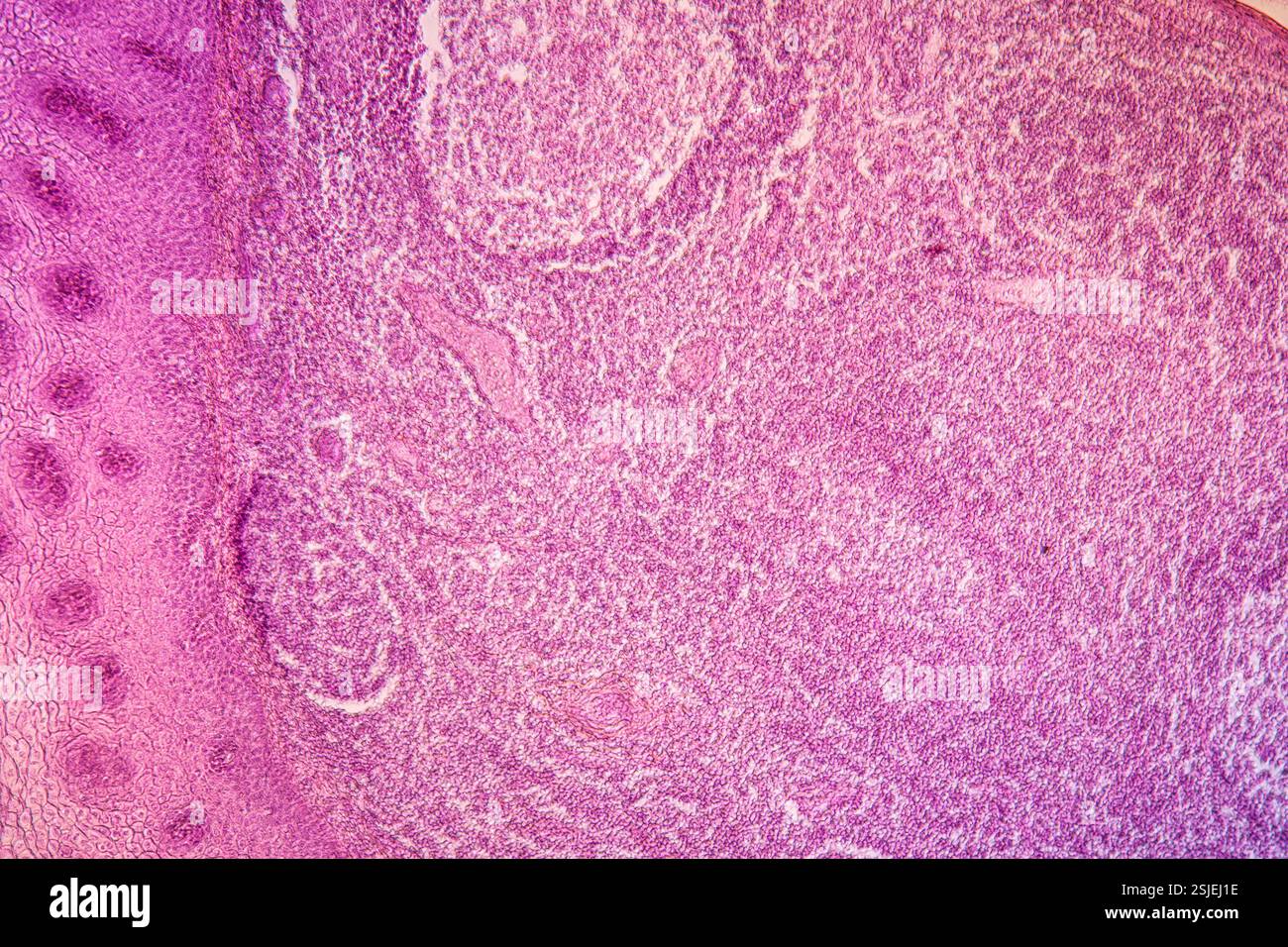 Tonsils diseased tissue 100x Stock Photo - Alamy