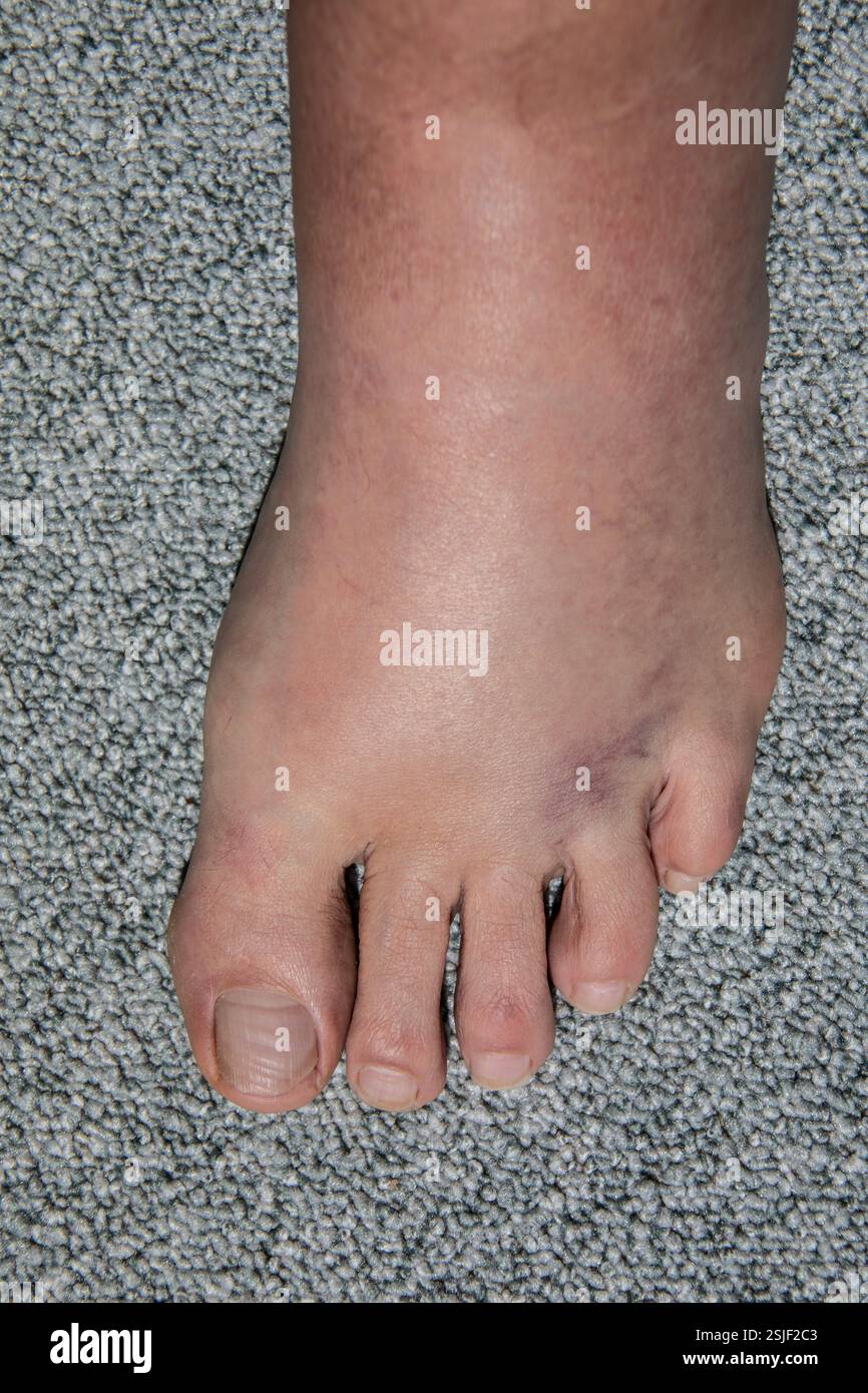 Severe swelling and hematoma of the left foot after twisting an ankle ...