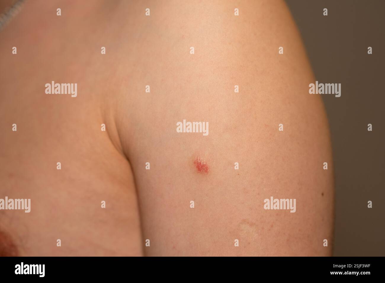 Red, itchy patches on the arm exhibit symptoms commonly associated with ...