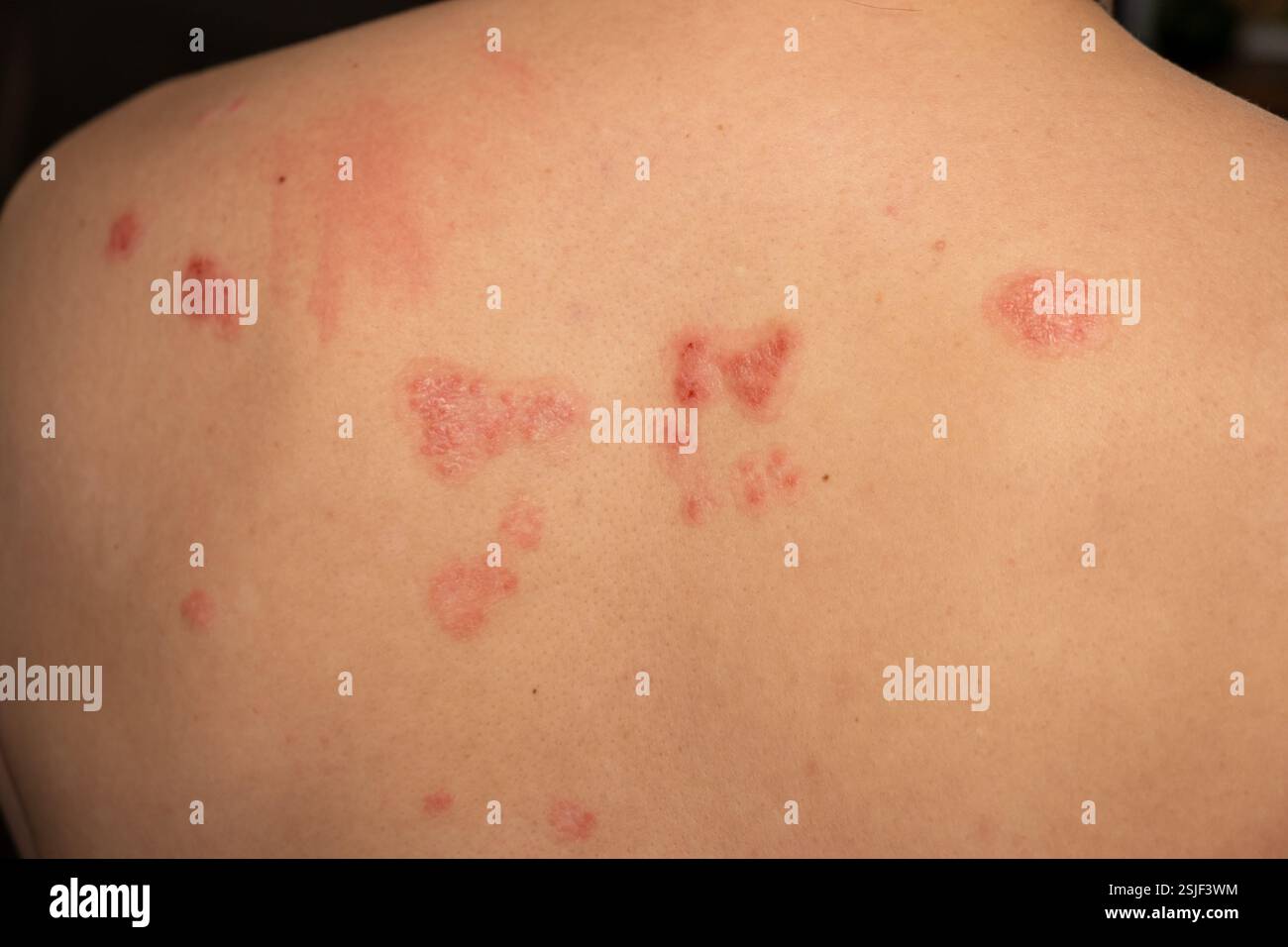 Skin patches affected by psoriasis display red, itchy, and scaly ...
