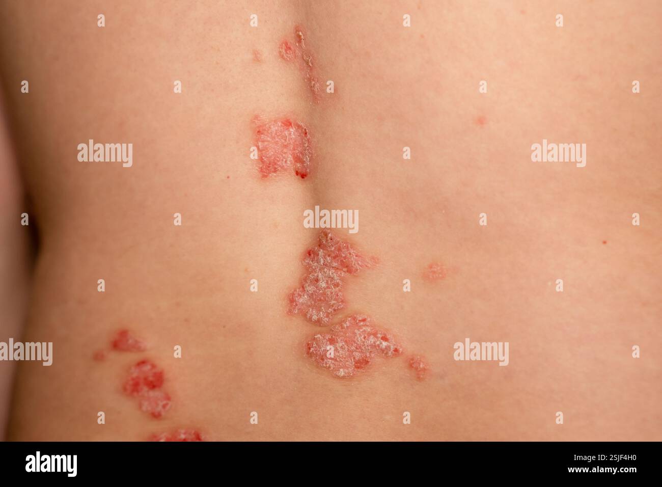 Psoriasis skin patches on a persons back showing red, itchy, and scaly spots indicative of this ...